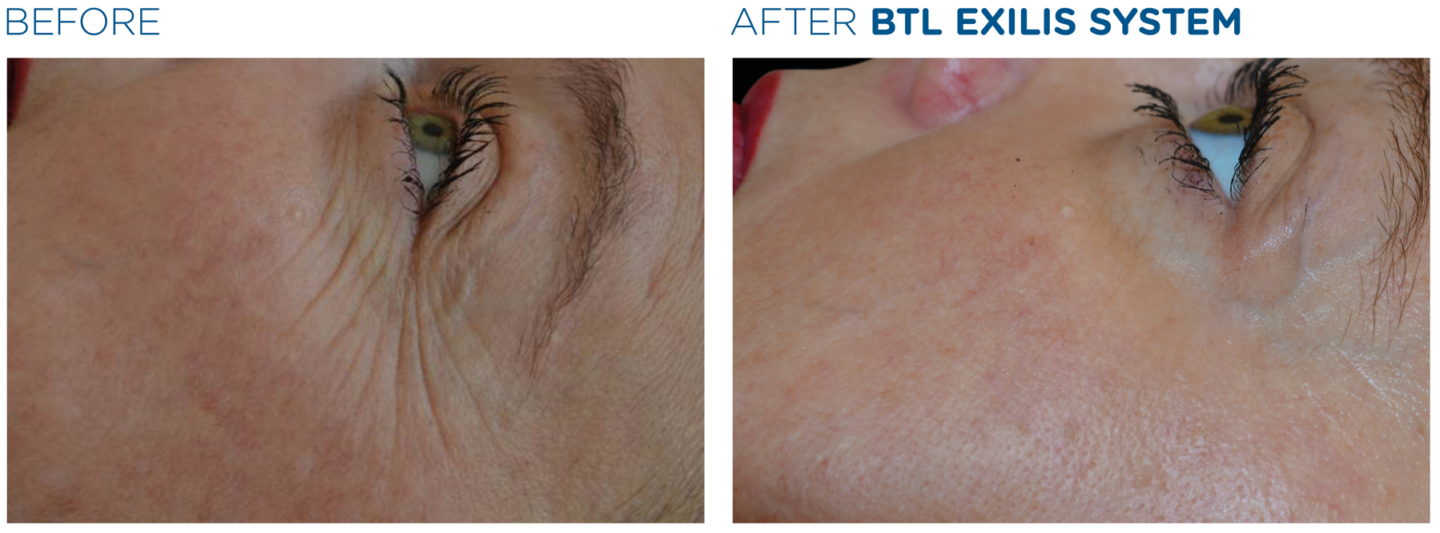Exilis Ultra™ Treatment in Johnstown at Elite Body & Med Spa